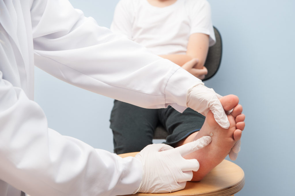 Wart Removal Clinic Calgary | Wart Treatment & Immune System Health