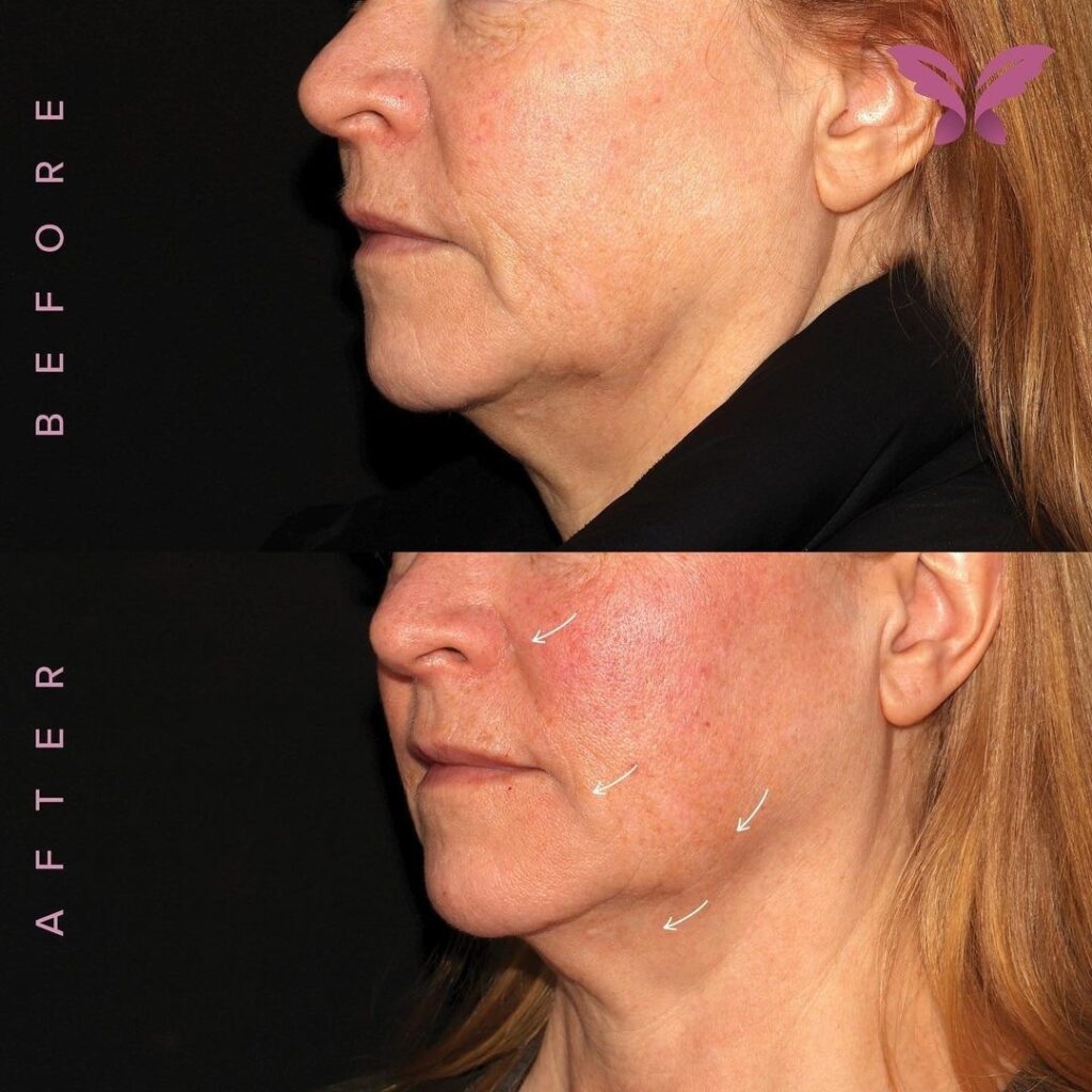 Volume Loss & Skin Laxity | Papillon Medical
