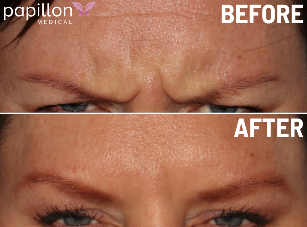 Volume Loss & Skin Laxity | Papillon Medical